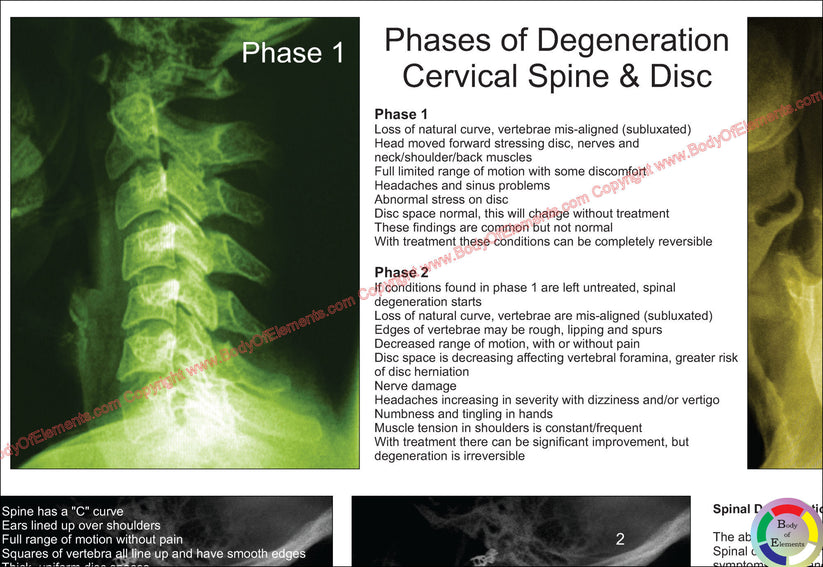 Spinal Degeneration Poster Cervical and Lumbar Spine – Body of Elements
