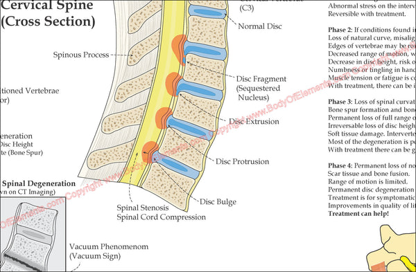Spinal Degeneration Disc Herniation Poster – Body of Elements