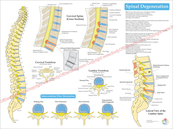 Spinal Degeneration Disc Herniation Poster – Body of Elements